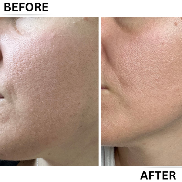 PlasmaGLO™ LED Face and Jowl Mask