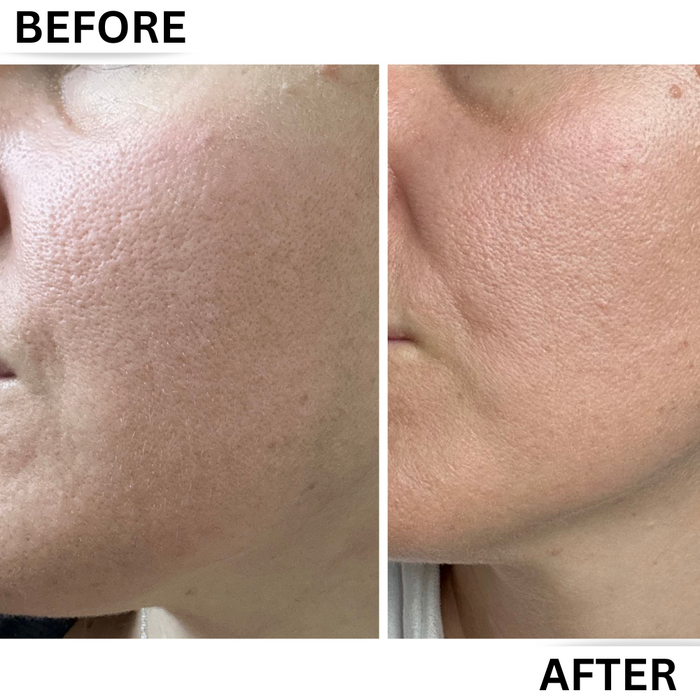 PlasmaGLO™ LED Face and Jowl Mask