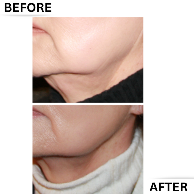 PlasmaGLO™ LED Face and Jowl Mask