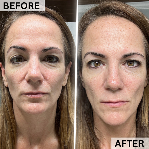 PlasmaGLO™ LED Face and Jowl Mask