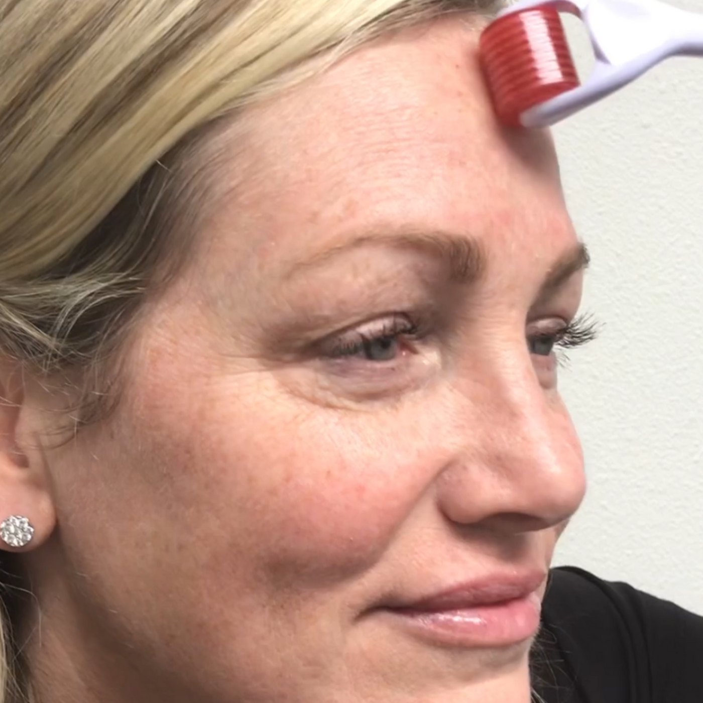 Dr Rajani's Micro-Needle Course