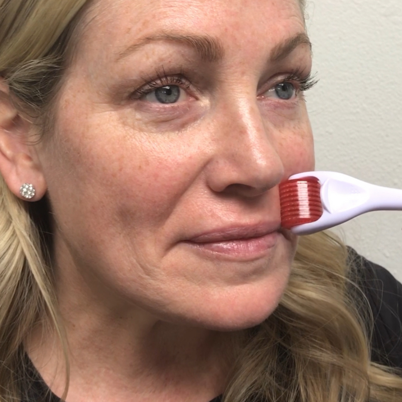 Dr Rajani's Micro-Needle Course