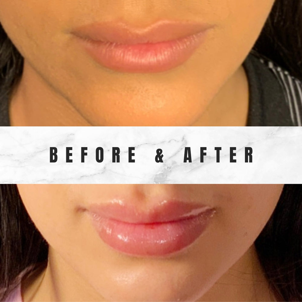 Lip Enhancer: Natural Full Lips, Short & Long-Term Benefits